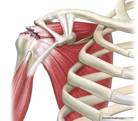 Fissure Tendon Épaule Rupture De Coiffe Des Rotateurs De L Epaule