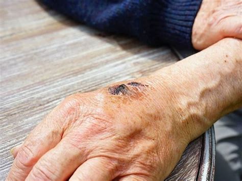 Piaghe Da Decubito Cosa Sono Cause E Trattamento