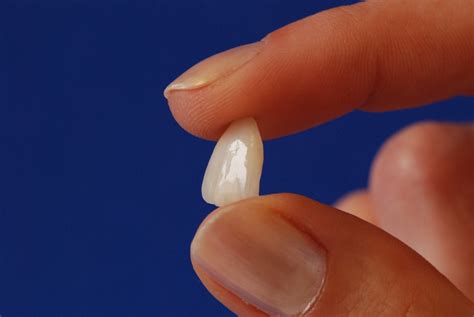 Conheça a lente de contato dental