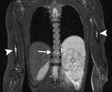Current And Emerging Roles Of Whole Body Mri In Evaluation Of Pediatric