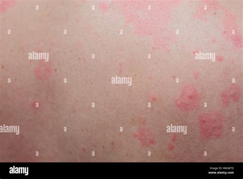 Close Up Allergy Rash Around Back View Of Human With Dermatitis