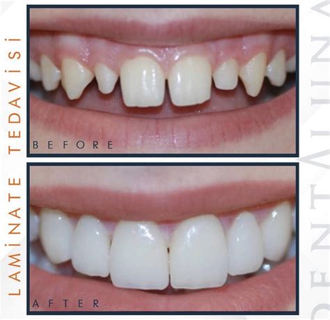 Laminate Porselenler Dentaluna Group A Z Ve Di Sa L Poliklini I
