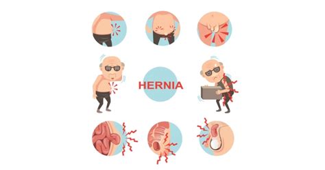 Hernia Surgery Types Causes Symptoms Treatment Options