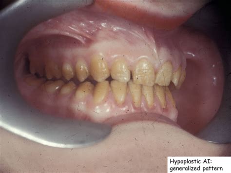 III TEETH ABNORMALITIES Flashcards Quizlet