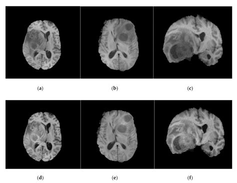 Sensors Free Full Text Brain MR Image Enhancement For Tumor