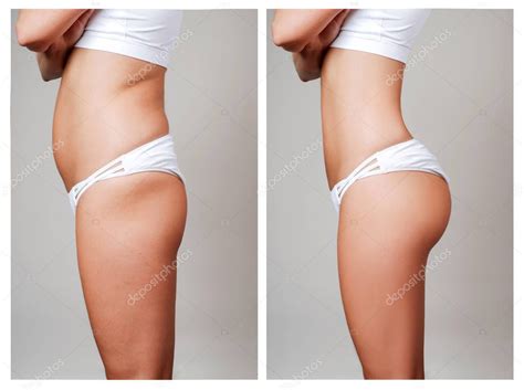 Cuerpo femenino antes y después del tratamiento Cirugía plástica 2023