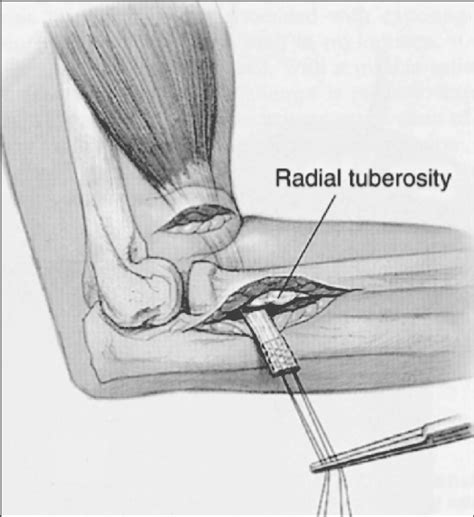 Distal Biceps Tendon Surgery