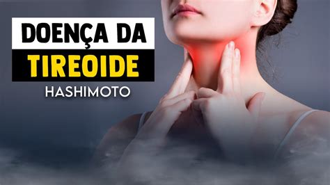 Doen A Da Tireoide Como Ela Afeta O Corpo E O Seu Pesco O
