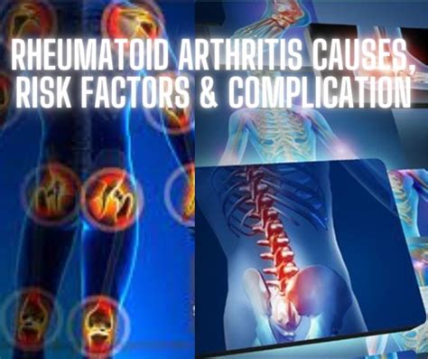 Risk Factors Complication Of Rheumatoid Arthritis Healthy Life With