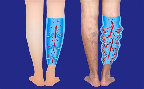 Varicose Veins Diagram St Louis Laser Veins