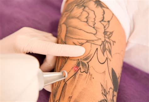 Métodos para eliminar tatuajes Club MAPFRE
