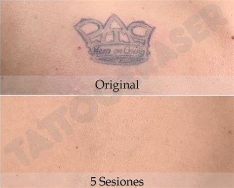 Quitar un tatuaje en 5 sesiones Antes y después Laserlight