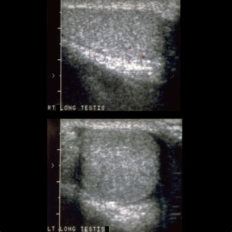 Testicular Torsion Intravaginal