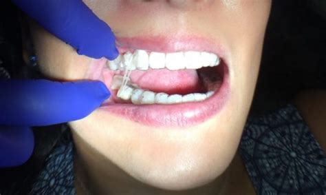 Teeth With Rubber Band Straightener Teeth Straightening Invisalign