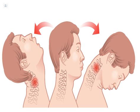 Latigazo Cervical La Importancia De Un Buen Tratamiento Centro Medici