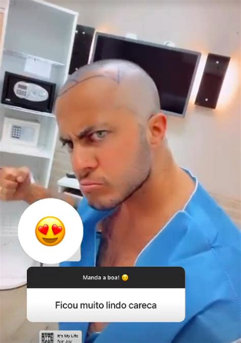 Thammy Miranda Faz Transplante Capilar Achei Que Ia Ficar Bem Mais