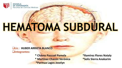 Hematoma Subdural Huber Joel Arrieta Blanco Udocz