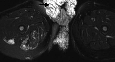 Mr Imaging Of The Penis And Scrotum Radiographics