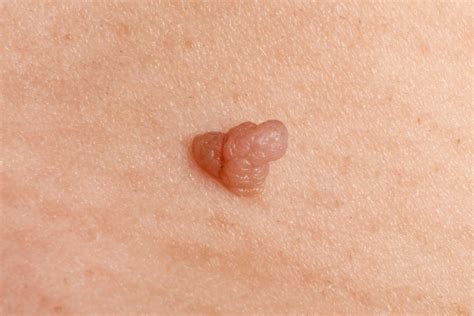 Verrugas Genitales Testiculos