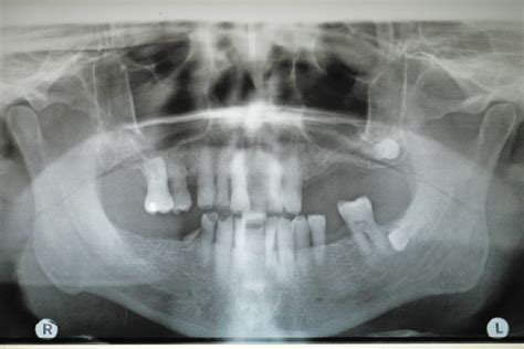 Full Mouth Rehabilitation With Dental Implants And Fixed Dental