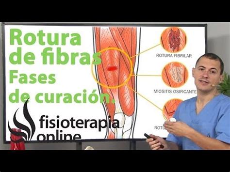 Rotura de fibras o fibrilar Proceso y fases de curación Desgarre