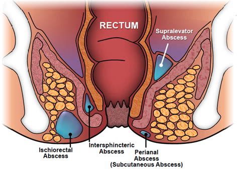 Anorectal Abscess Anatomy