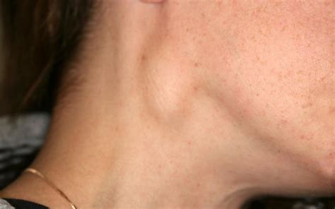 Swollen Lymph Nodes Neck Strep Throat