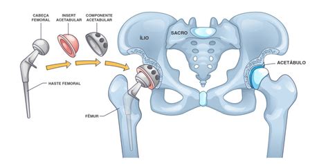 Prótese de Quadril Cirurgia de Quadril