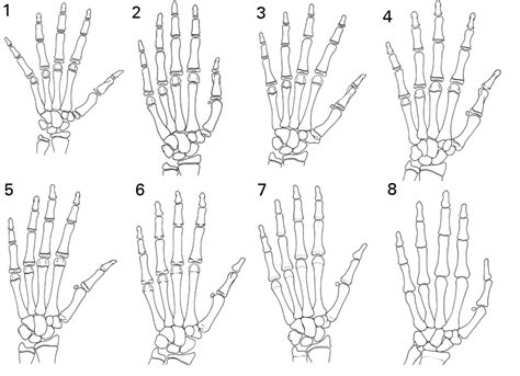 The Relationship Of Calcaneal Apophyseal Ossification And Sanders Hand