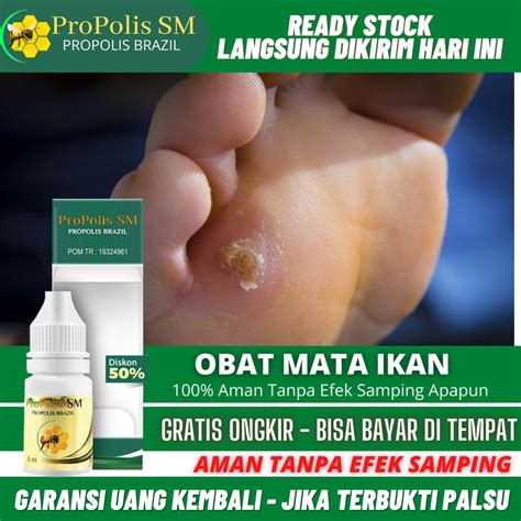 Jual Obat Tetes Perontok Mata Ikan Di Telapak Kaki Obat Mata Ikan Di