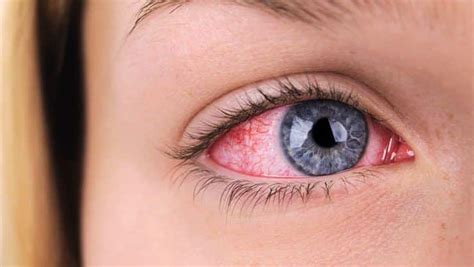 Remela como são formadas Causas de acúmulo nos olhos