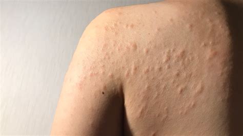 Cholinergic Urticaria Mbbch Health Encyclopedia