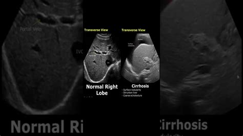 Liver Cirrhosis On Ultrasound Ascites Chronic Liver Disease Usg