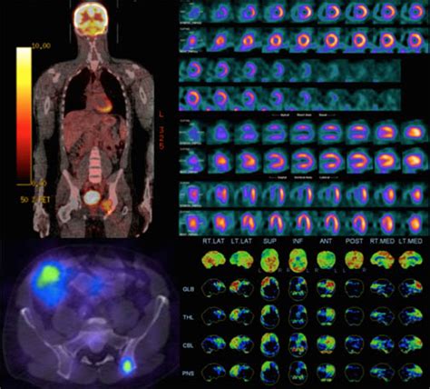 Nuclear Medicine PET CT Fellowship Non ACGME UW Radiology