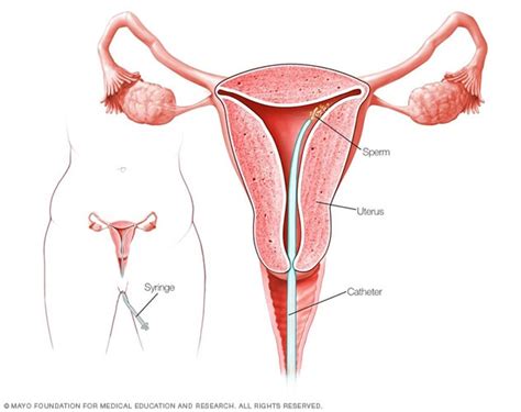 Intrauterine Insemination IUI Mayo Clinic