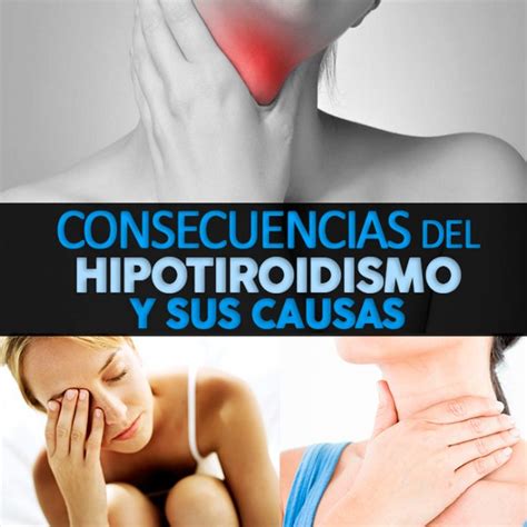 Consecuencias Del Hipotiroidismo Cabello Delgado Infartos Cardiacos Y