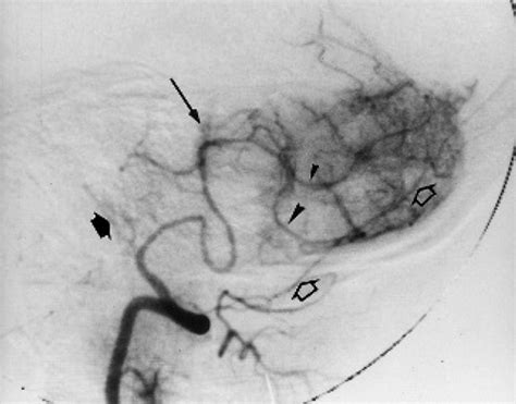 Arteries Of The Head And Neck Radiology Key