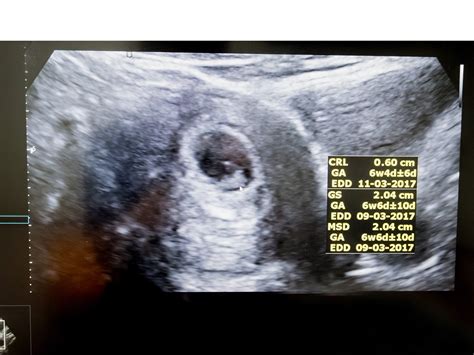 Ultrasound Weeks Pregnant With Twins Belly Pregnantbelly