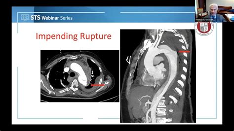 Management Of Type B Aortic Dissection Takeaways From The STS AATS