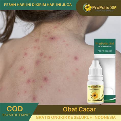 Jual Obat Cacar Obat Cacar Air Obat Penghilang Bekas Cacar Obat