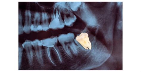 Extração de Dente Siso Quando É Indicado Ortocenter