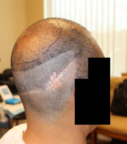 Botched Hair Transplant Surgeries Continue To Rise Modena Hair Institute