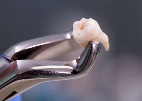 Extração do dente como se preparar para a cirurgia RIZI