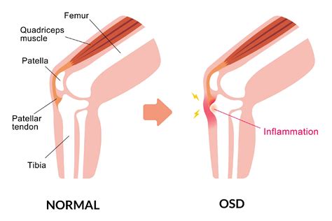 From Pain To Relief Finding The Right Treatment For Osgood Schlatter