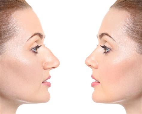 Rinoplastia o que você precisa saber antes de fazer Clínica Art