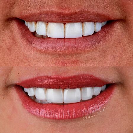 Antes y después diseño de sonrisa carillas dentales de Sergi Ríos