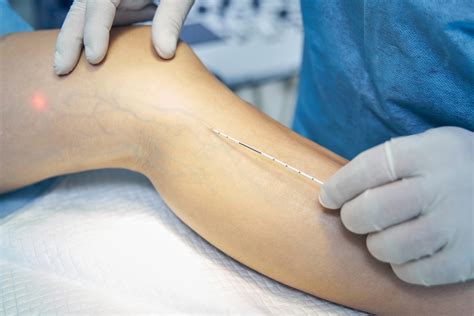 Flebologia Laserowe usuwanie żylaków Flebetica