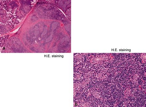 A New Category For Chronic Sclerosing Sialadenitis As An Igg Related