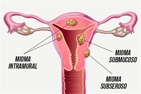Tipos De Mioma Uterino Principais Sintomas E Como Tratar Tua Sa De
