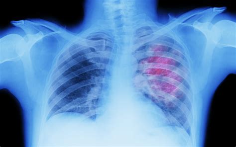 Musculoskeletal Manifestations Linked To ATTR Amyloidosis